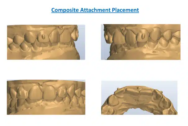Invisible Braces And Clear Aligners In London | Smile Cliniq