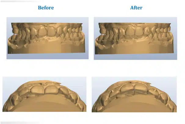 Invisible Braces And Clear Aligners In London | Smile Cliniq