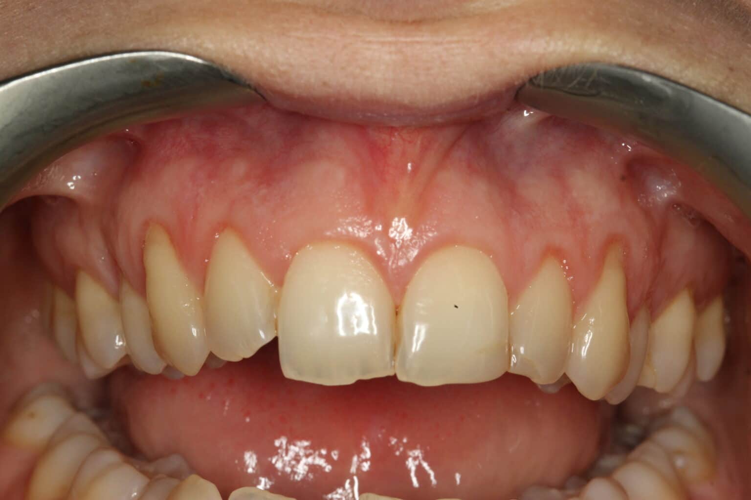 Receding Gums Treatment London | Smile Cliniq