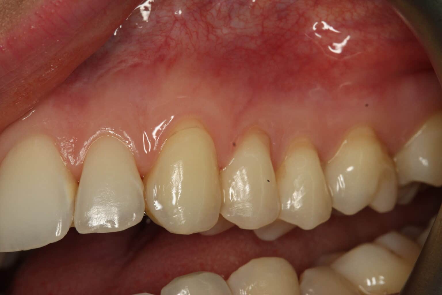 Receding Gums Treatment London | Smile Cliniq