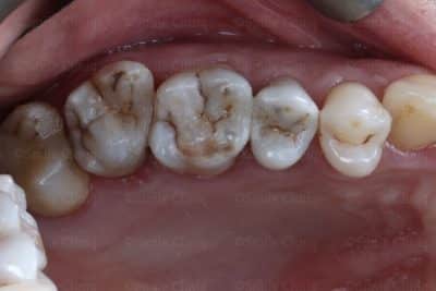 Smart Mercury Amalgam Removal, Filling Removal London