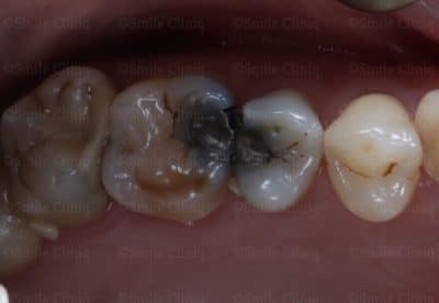 Smart Mercury Amalgam Removal, Filling Removal London