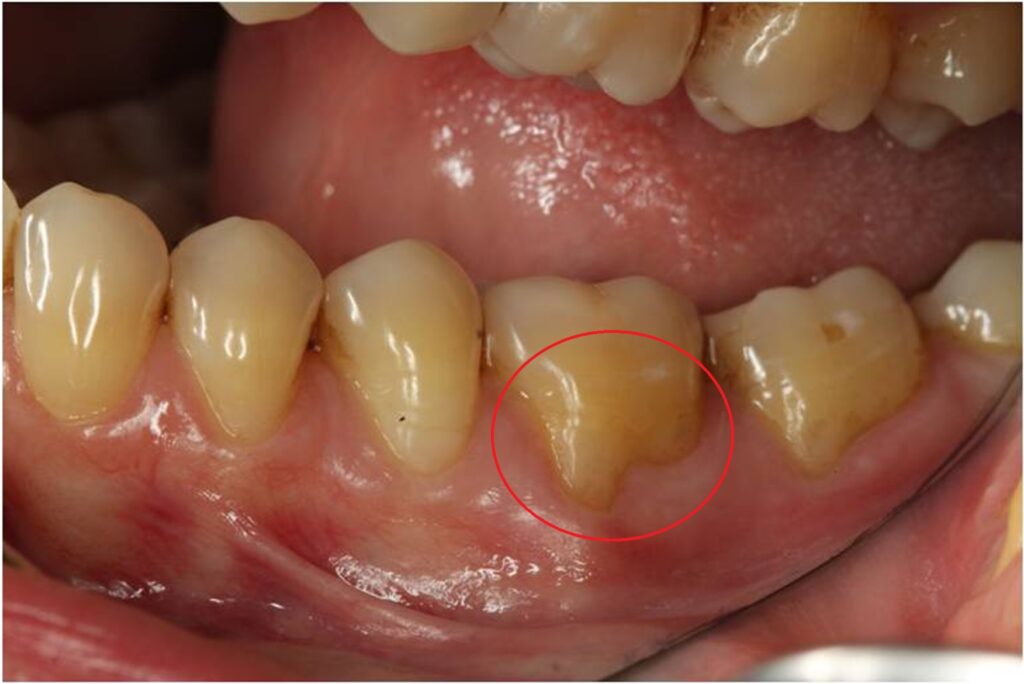 Receding Gums Treatment London | Smile Cliniq