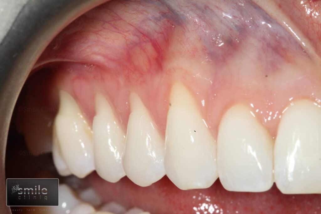 Receding Gums Treatment London | Smile Cliniq