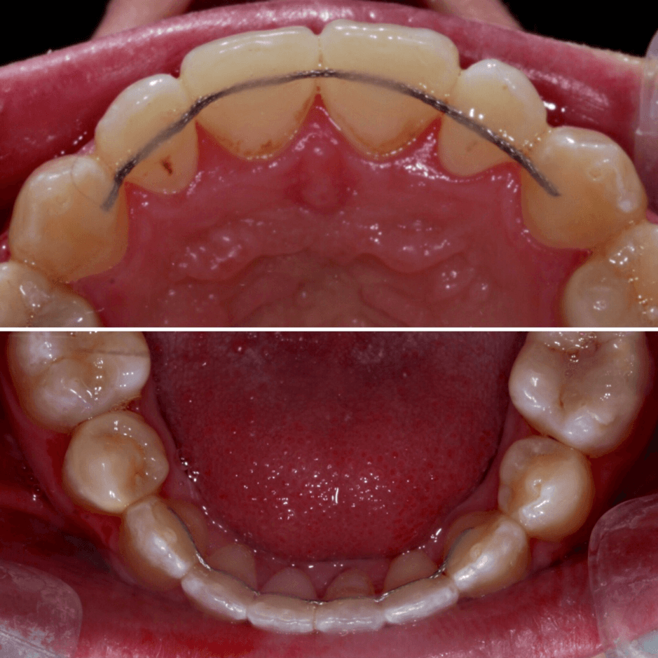 The importance of wearing an orthodontic retainer! - Smile Cliniq The importance of wearing an orthodontic retainer! - Smile Cliniq