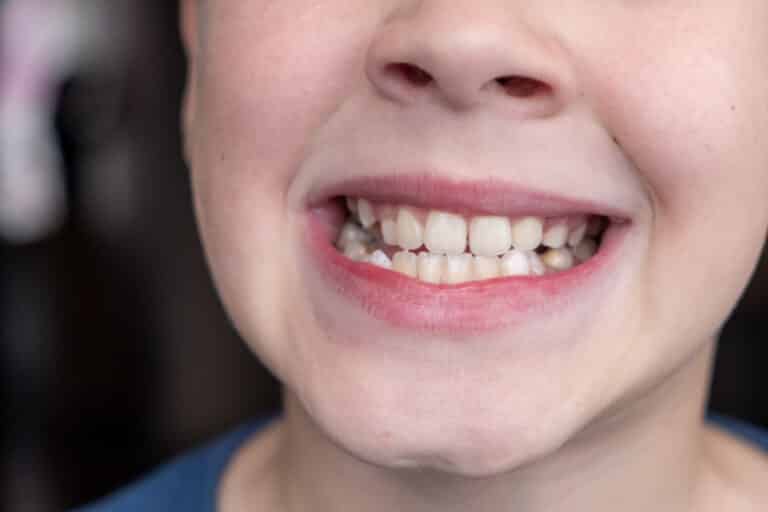 Peg Teeth: Causes, Treatment, And Symptoms | Smile Cliniq