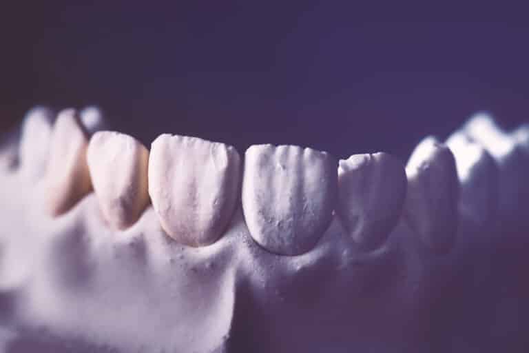 Peg Teeth: Causes, Treatment, And Symptoms | Smile Cliniq