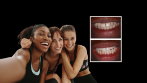 Peg Teeth: Causes, Treatment, And Symptoms | Smile Cliniq