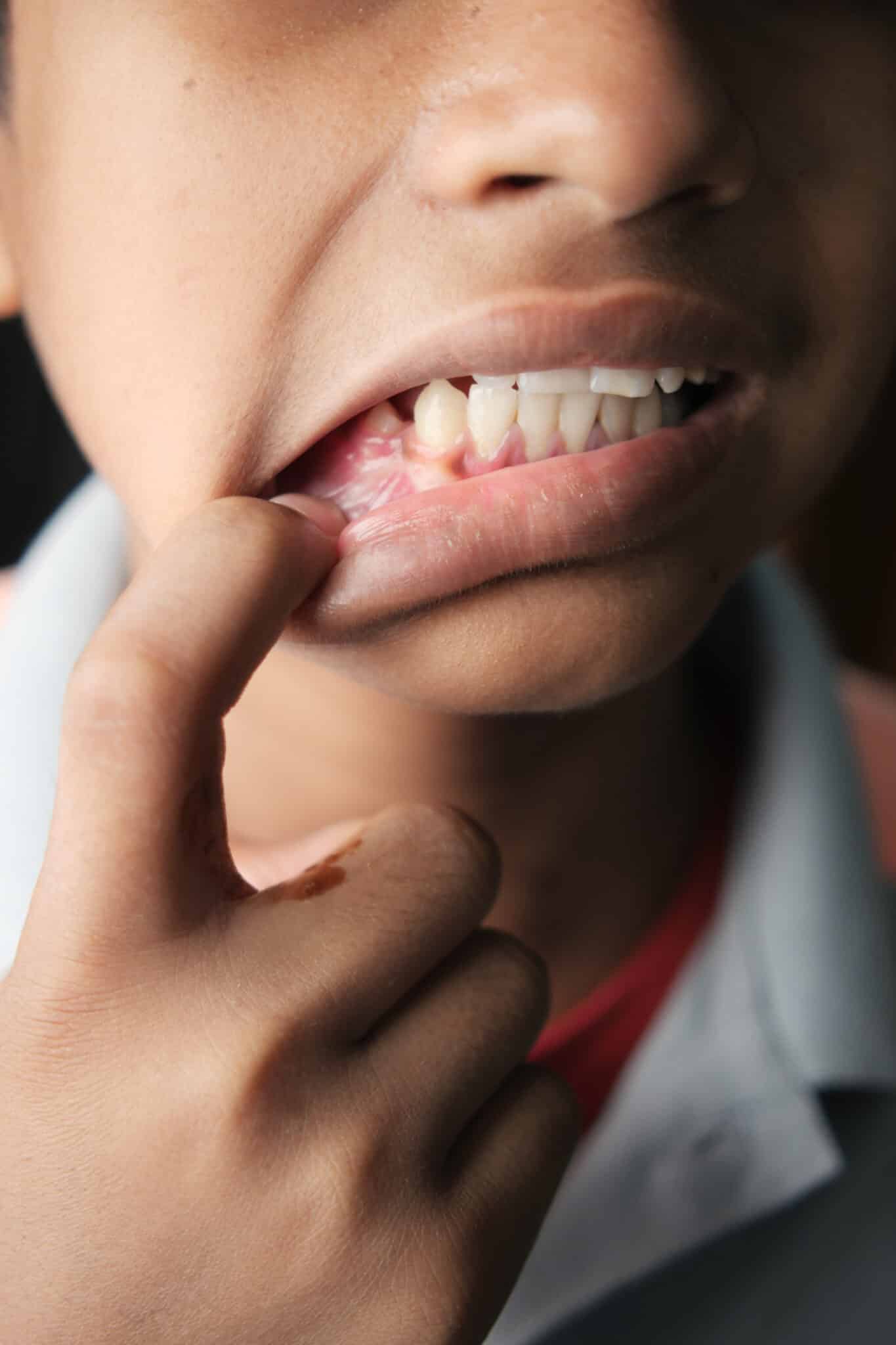 Peg Teeth: Causes, Treatment, And Symptoms | Smile Cliniq