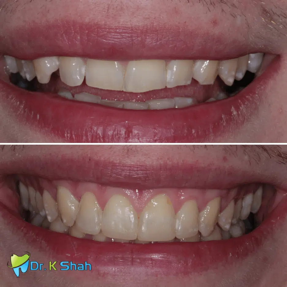 Fast Braces London, Leading Fast Braces Specialist In London