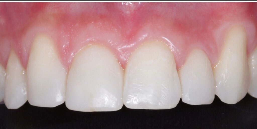 Peg Teeth: Causes, Treatment, And Symptoms | Smile Cliniq