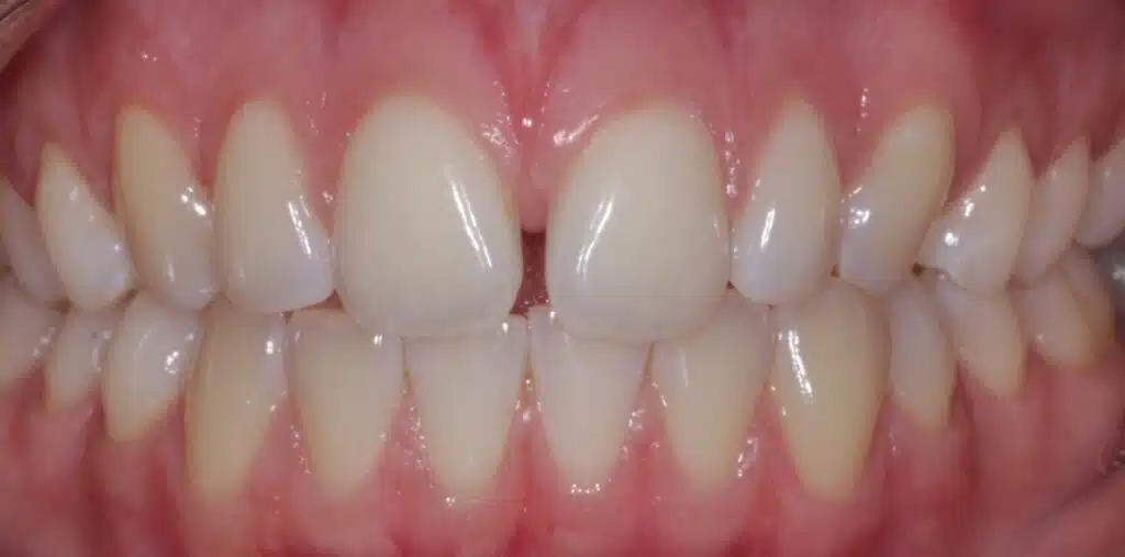 Diastema Closure London, Book A Consultation Online Now