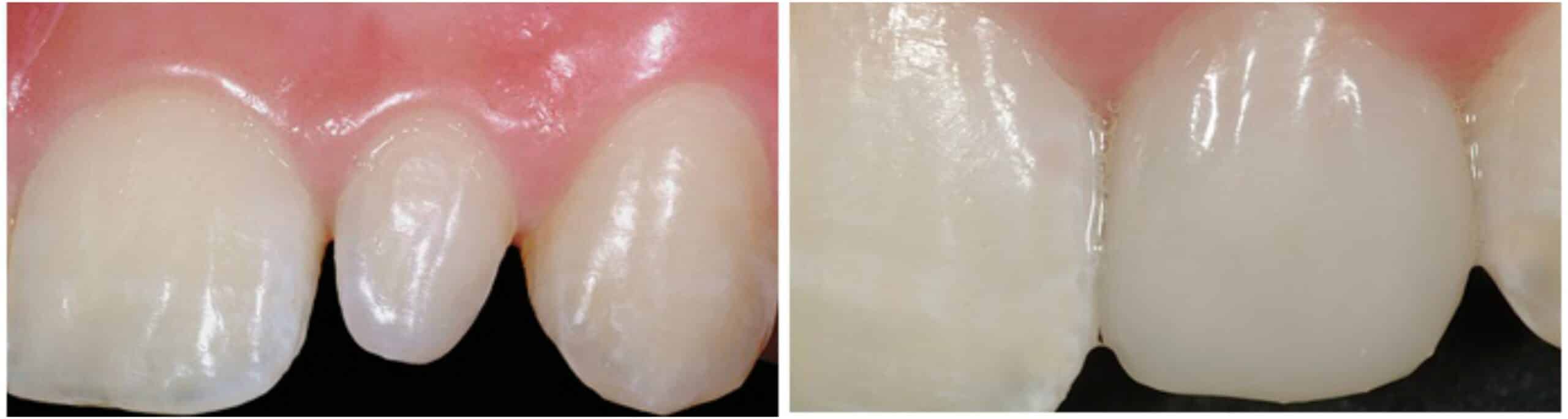 Peg Teeth: Causes, Treatment, And Symptoms | Smile Cliniq
