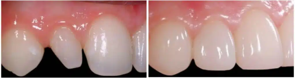 Peg Teeth: Causes, Treatment, And Symptoms | Smile Cliniq