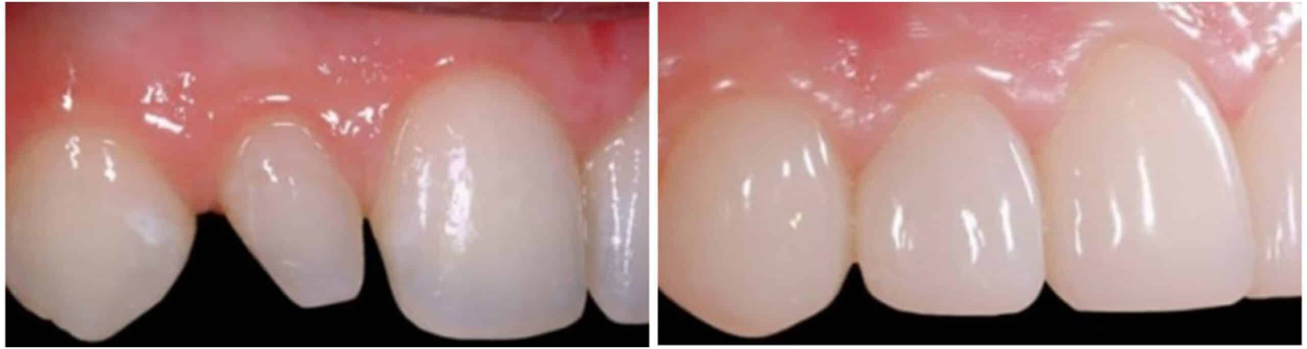 Peg Teeth: Causes, Treatment, And Symptoms | Smile Cliniq