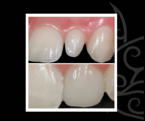 Peg Teeth: Causes, Treatment, And Symptoms | Smile Cliniq