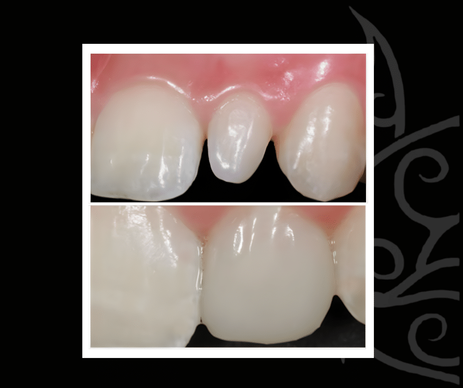 Peg Teeth: Causes, Treatment, And Symptoms | Smile Cliniq