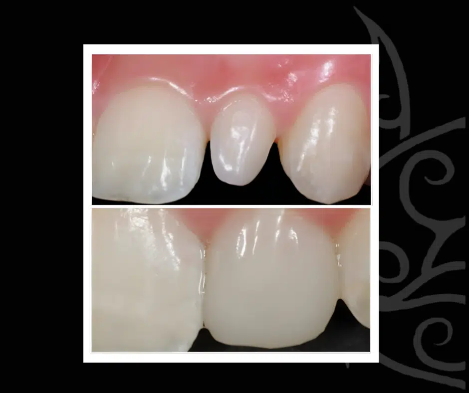 Peg Teeth: Causes, Treatment, And Symptoms | Smile Cliniq