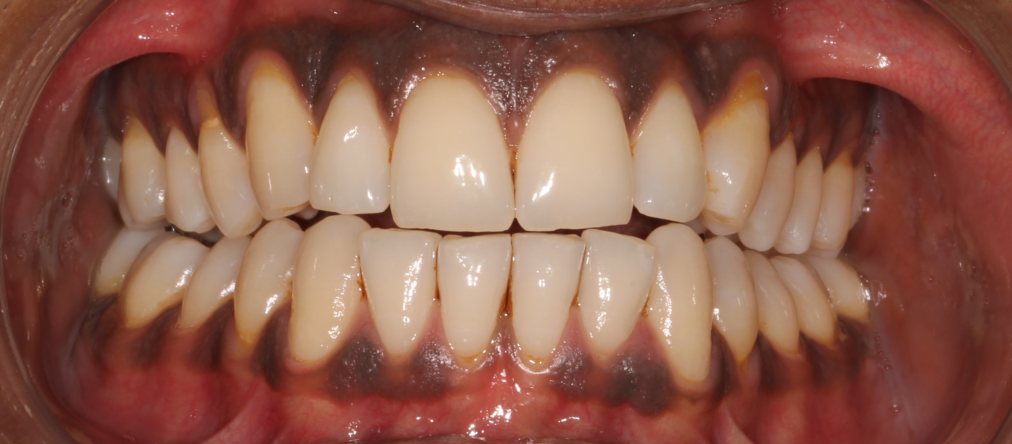 Laser Gum Bleaching, Book Laser Gum Bleaching Today