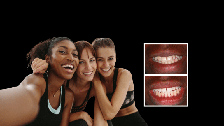 Peg Teeth: Causes, Treatment, And Symptoms | Smile Cliniq