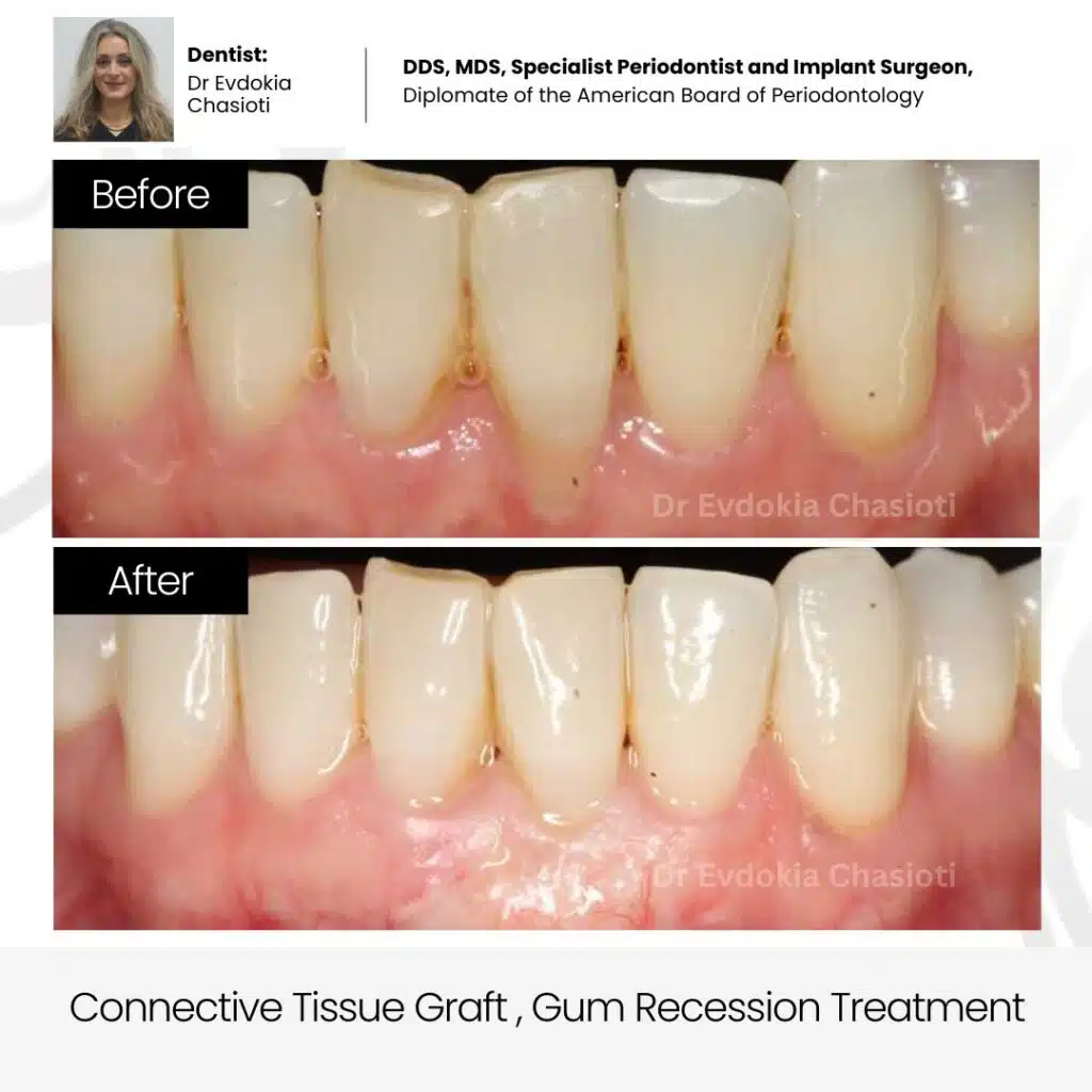 Fix Receding Gums Graft Repair Boynton Beach Gum