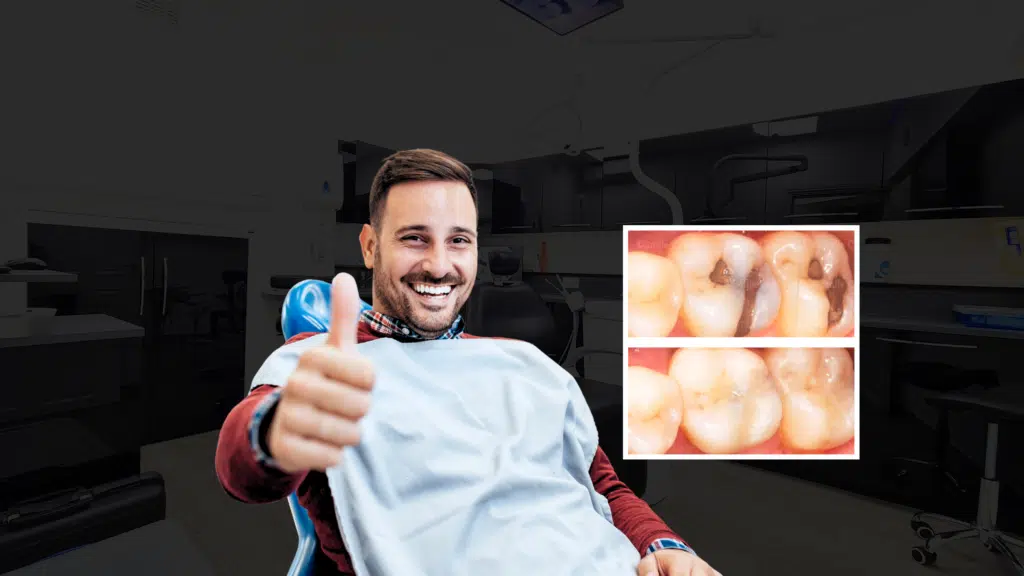 Smart Mercury Amalgam Removal, Filling Removal London